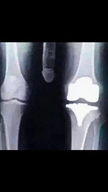 Knee replacement